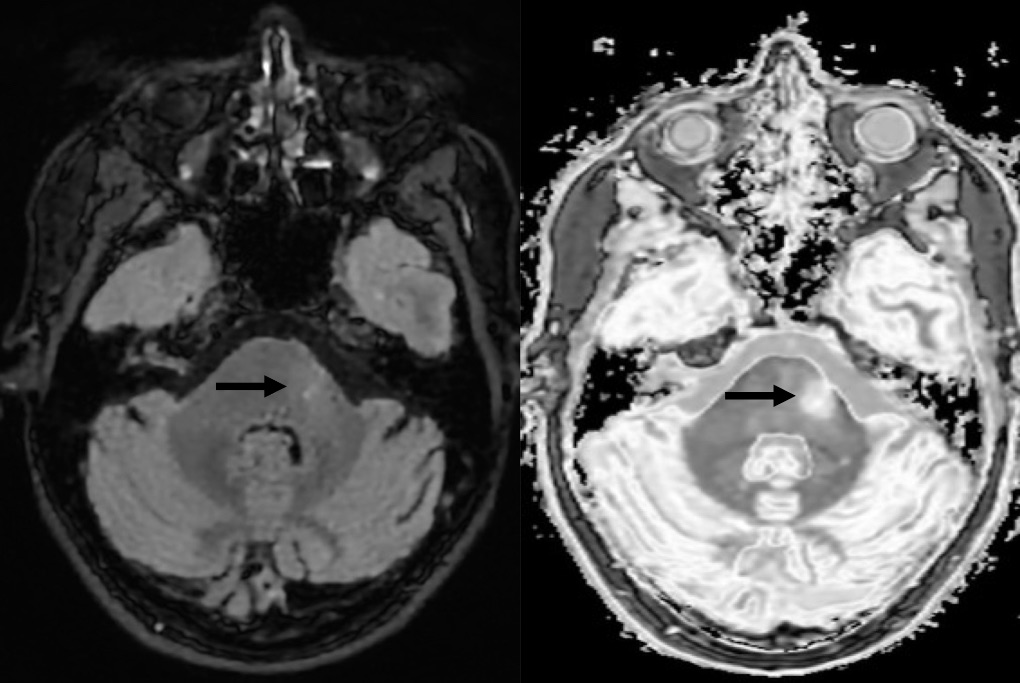 MRI Method Uncovers Invisible MS Lesions | Scoop News